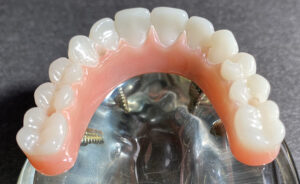 Premium Fixed Resin Full Arch - Detail Dental