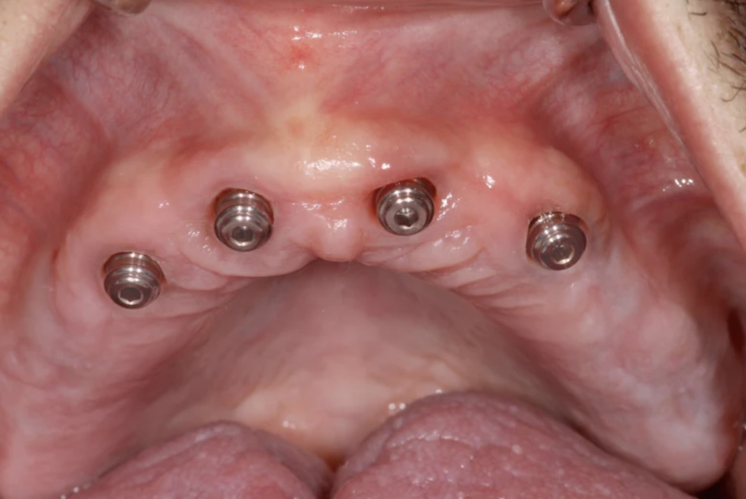 Removable Hybrid Denture - Detail Dental