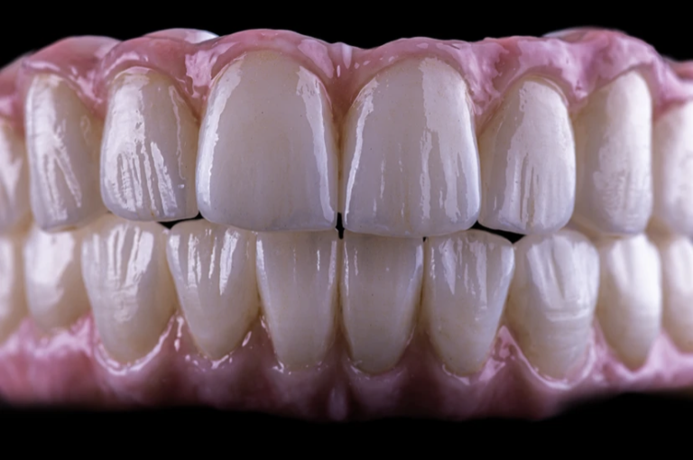 Fixed Zirconia Full Arch Teeth Express - Detail Dental