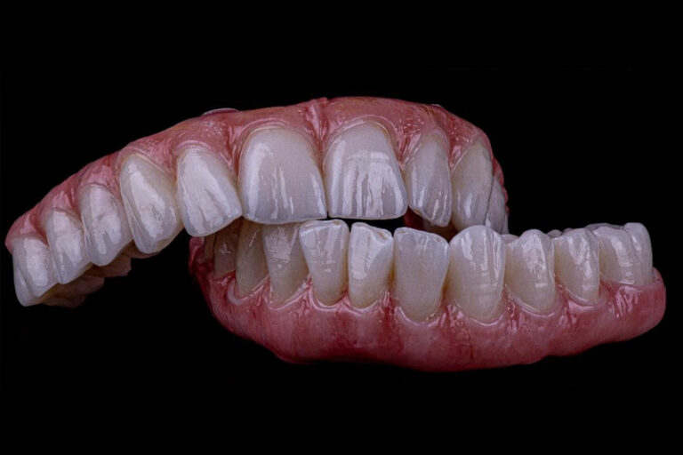 Fixed Zirconia Full Arch Teeth Express - Detail Dental